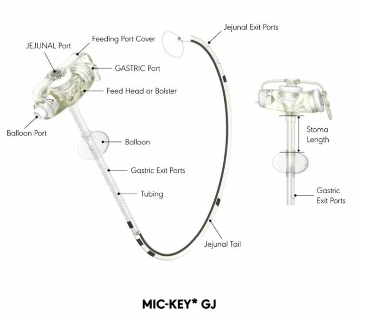 MIC-KEY GJ-tube 18fr-2.5cm-30cm | Icepharma